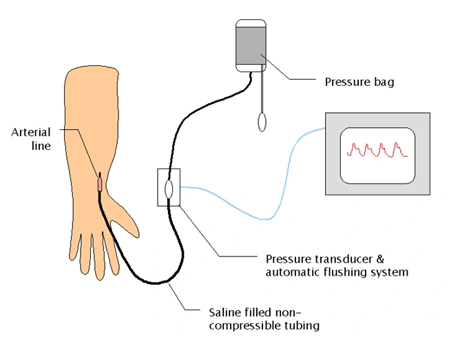 Invasive Blood Pressure | BMET Wiki | Fandom powered by Wikia